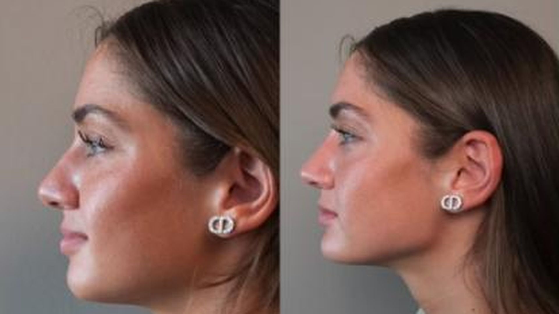 Nasen- und Kinnkorrektur: Tanja Makarić war beim Beauty-Doc